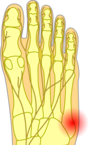 La maladie d’Iselin | label-orthopedie